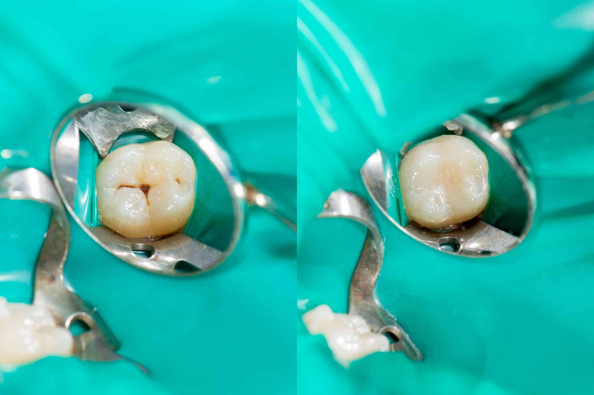 Προληπτικά Σφραγίσματα (Sealants)