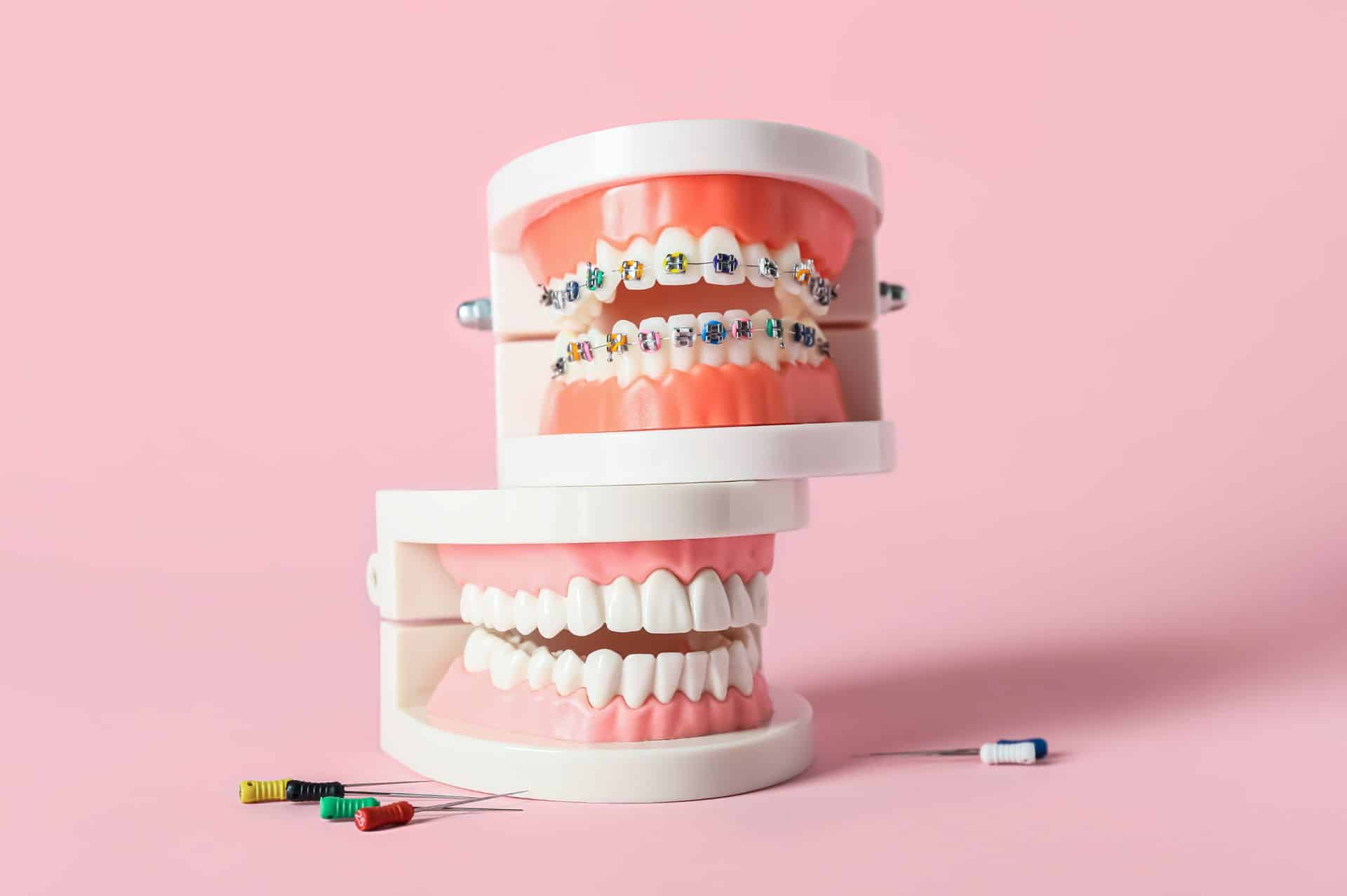 Ορθοδοντική Αθήνα | Διαφανείς Νάρθηκες - Oralis Dental